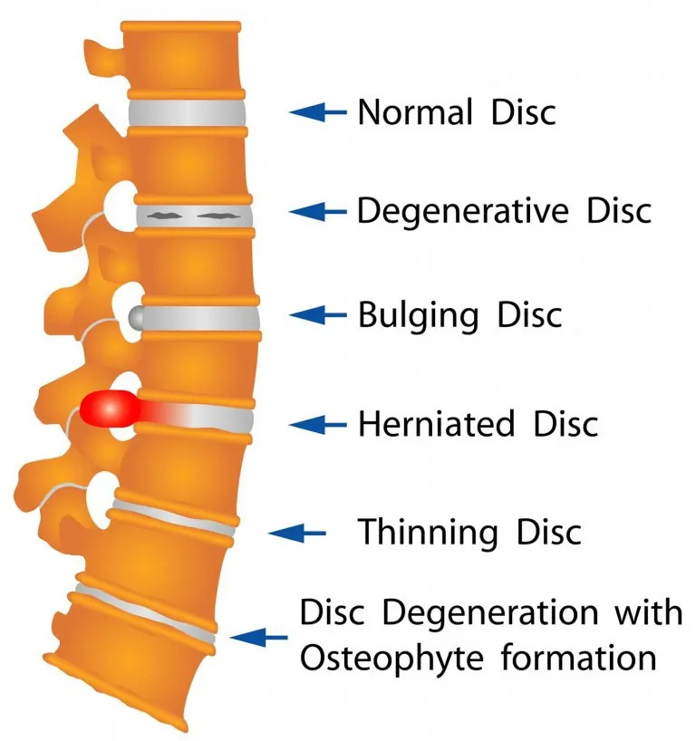 Disc Injuries - Synergy Spine & Health